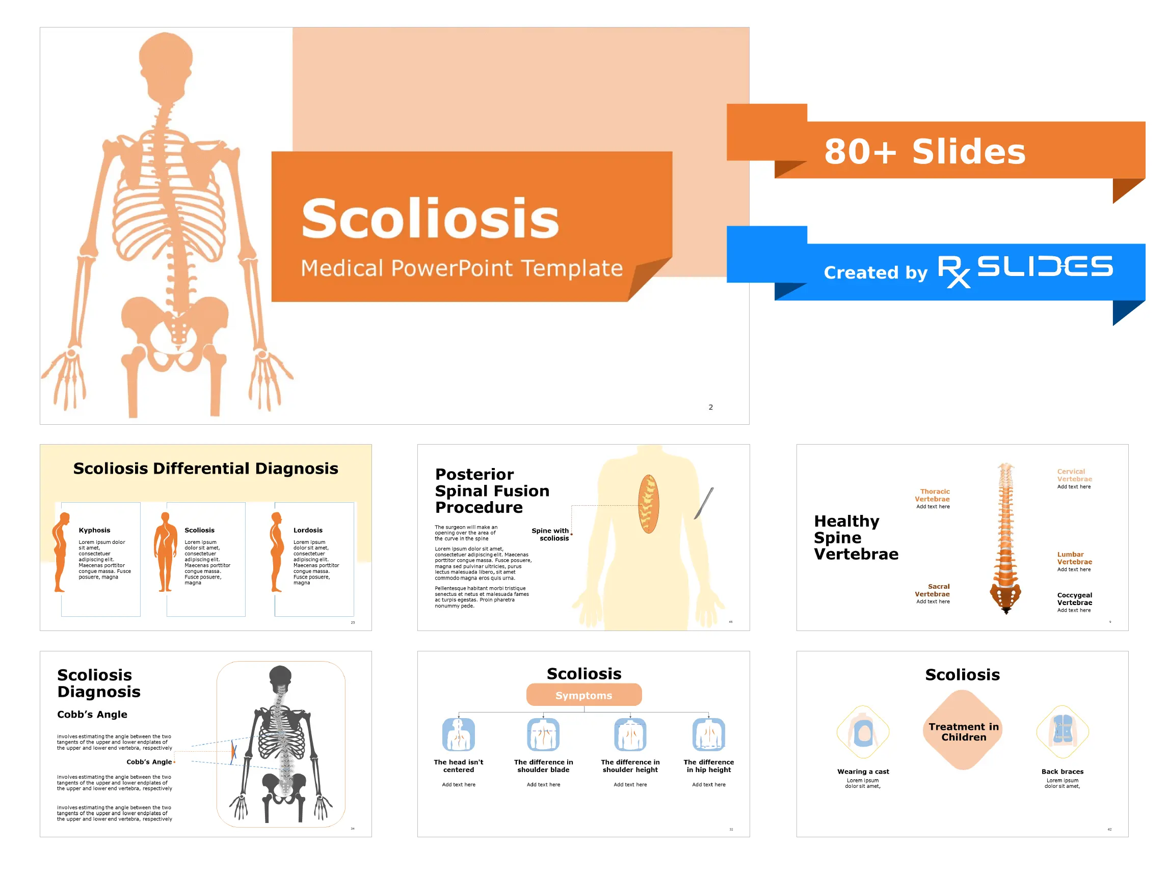 Download Scoliosis PowerPoint Template|RxSlides